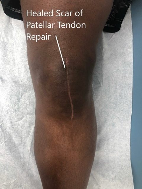 Case Study: Patellar Tendon Rupture in 70 Year Old Male