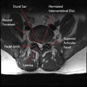 Percutaneous Lumbar Disc Laser Decompression - Complete Orthopedics