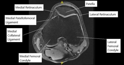 Medial Patellofemoral Ligament Reconstruction - Complete Orthopedics