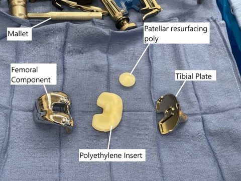 Minimally Invasive Vs Total Knee Replacement - Complete Orthopedics