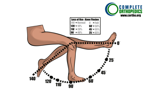 Scheduled Loss of Use for Knee and Tibia - Complete Orthopedics