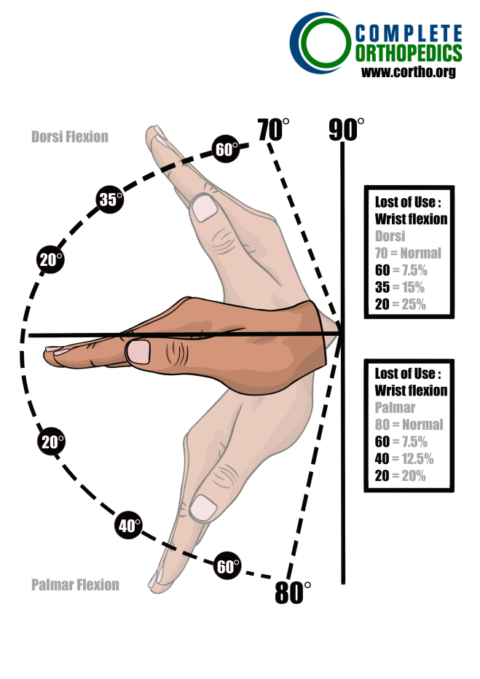Scheduled Loss of Use for Hand and Wrist - Complete Orthopedics