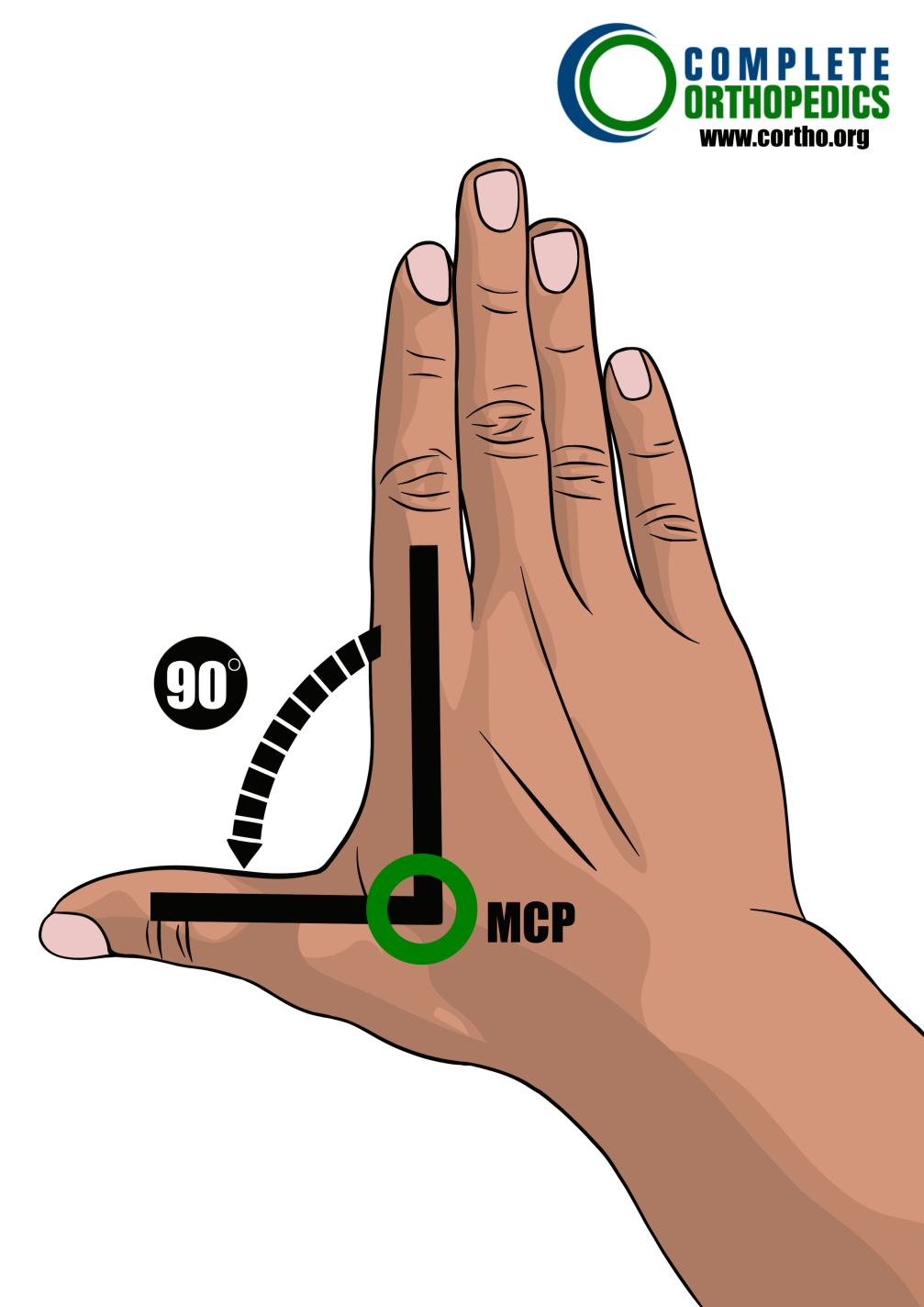 Scheduled Loss of Use for Upper Extremities - Complete Orthopedics Scheduled Loss of Use for Upper Extremities - Complete Orthopedics
