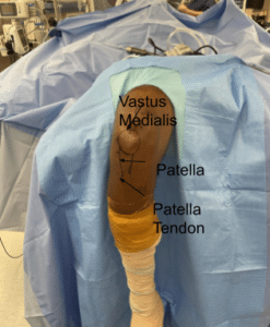 Reconstruction ACL using Quadriceps Tendon Autograft