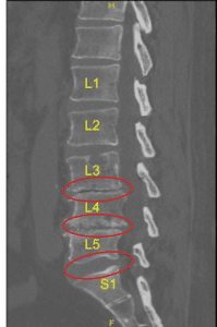 Case Study: Anterolateral lumbar discectomy and arthrodesis via left ...