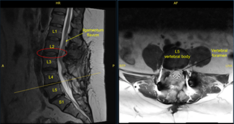 Laminectomía L2-3 y descompresión de revisión L3-4