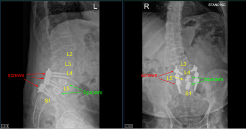 L4 to S1 Transforaminal Lumbar Fusion | Complete Orthopedics