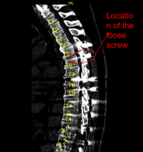 T6 to T11 Instrumented Fusion | Complete Orthopedics | NY