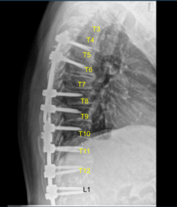 T6 to T11 Instrumented Fusion | Complete Orthopedics | NY