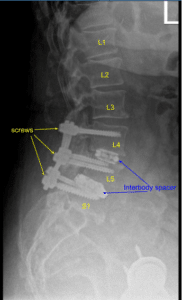 L3-S1 Laminectomy and Fusion | Complete Orthopedics NY