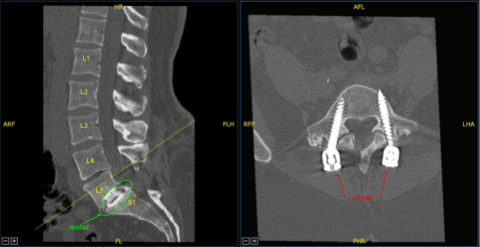 L4-S1 Transforaminal Interbody Fusion | Complete Orthopedics