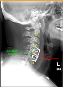 C4 to C6 Anterior Cervical Discectomy | Complete Orthopedics