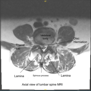 L4-5 Laminectomy and Discectomy | Complete Orthopedics