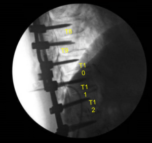 T6 to T11 Instrumented Fusion | Complete Orthopedics | NY