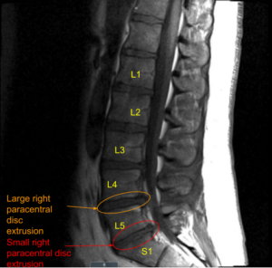 Transforaminal Lumbar Fusion L4-S1 | Complete Orthopedics