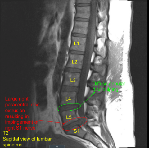 Estudio de caso: laminotomía derecha L5-S1, microdiscectomía