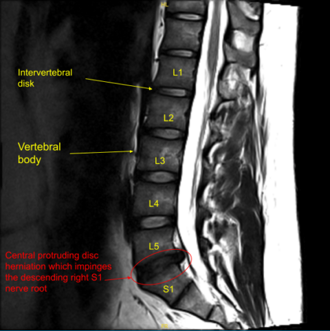Case Study: Nerve Root Transforaminal | Complete Orthopedics