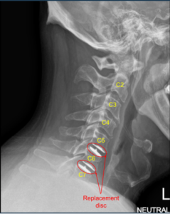 Case Study: Cervical Disc Replacement | Complete Orthopedics