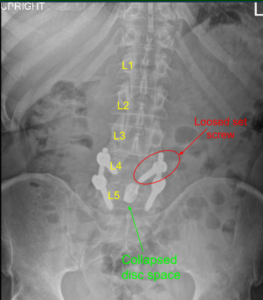 Revision decompression of L4-L5 | Complete Orthopedics | NY