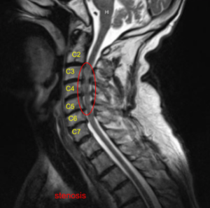 Insertion of Interbody Titanium Cage Globus, C3-4, C4-5 and C5-6