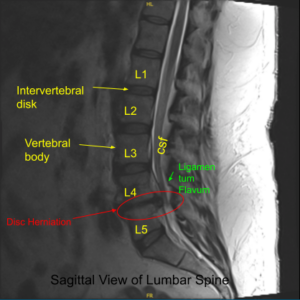 L4-5 Laminectomy and Discectomy | Complete Orthopedics