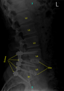 Transforaminal Lumbar Fusion L4-S1 | Complete Orthopedics