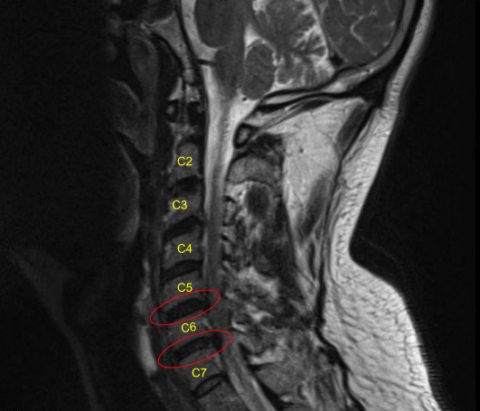Case Study: Cervical Disc Replacement | Complete Orthopedics