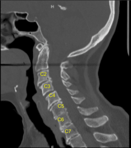 Case Study: Anterior Cervical Discectomy and Fusion C3 TO C6