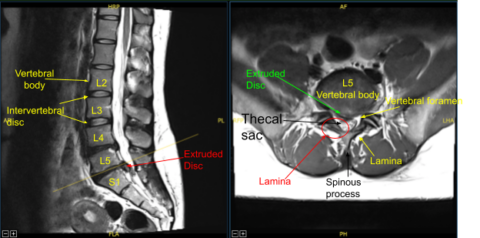 Estudio de caso: Laminotomía L5 derecha mínimamente invasiva (tubular) con microdiscectomía L5 ...