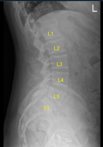 Laminectomía L4, L5 y S1 con neurólisis: Estudio de caso
