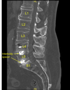 Case Study: Exploration of Spinal Fusion | L4 and L5