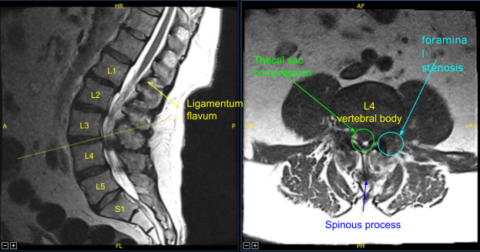 Estudio de caso: Laminectomía L3-4 - Ortopedia completa