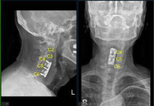 Complete Orthopedics C4-5 and C5-6 Anterior | Cervical & Fusion