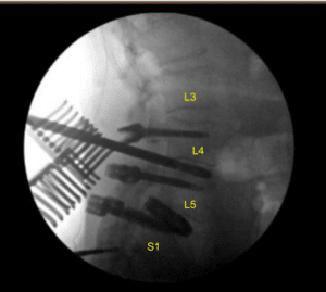 L3-S1 Laminectomy and Fusion | Complete Orthopedics NY