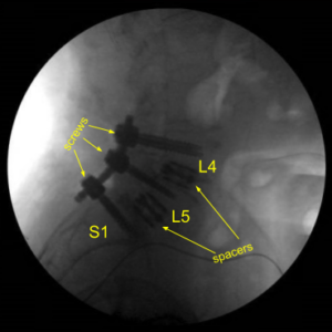 L4 to S1 Transforaminal Lumbar Fusion | Complete Orthopedics