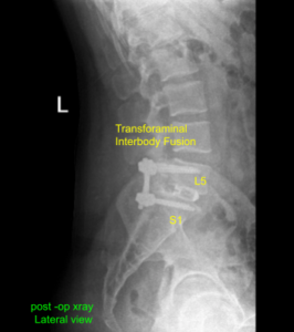 Transforaminal Interbody Fusion with Pedicle screw | L5-S1