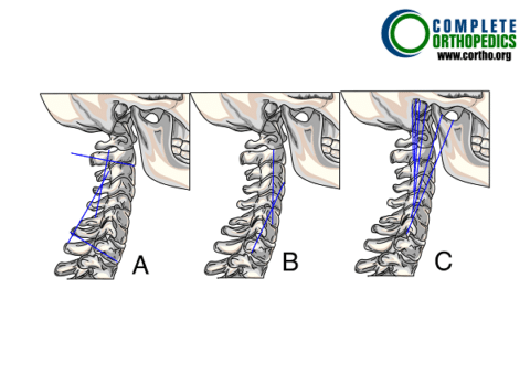 La alineación cervical y su impacto en la salud de la columna vertebral ...