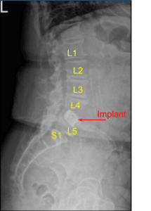 L4/5 Bilateral Laminectomies | Complete Orthopedics NY