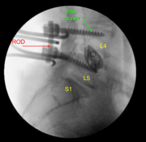 L4/5 Bilateral Laminectomies | Complete Orthopedics NY