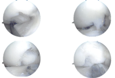 Knee Arthroscopy: Chondroplasty & Medial Meniscectomy