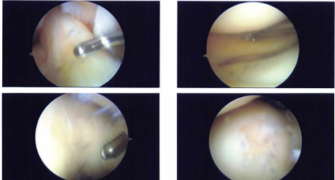 Arthroscopy | Medial Meniscus of Knee | Complete Orthopedics