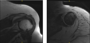Case Study: Arthroscopic Debridement, Decompression, Acromioplasty and ...