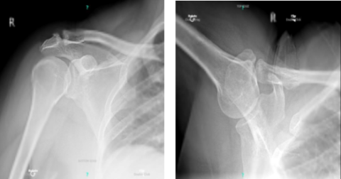 Case Study: Shoulder Arthroscopy with Rotator Cuff Repair (Speed Bridge ...