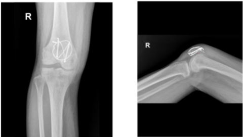 Case Study: Open Reduction Internal Fixation: Closed Fracture of ...