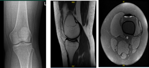 Case Study: Repair of the Lateral Meniscus of the left knee with a use ...