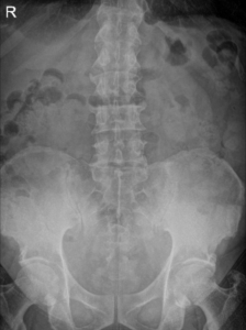 Case Study: Right Knee Arthroscopic: Medial Meniscectomy and Plica ...
