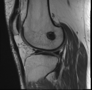 Case Study: Medial Meniscectomy Repair for 26 year old male patient ...