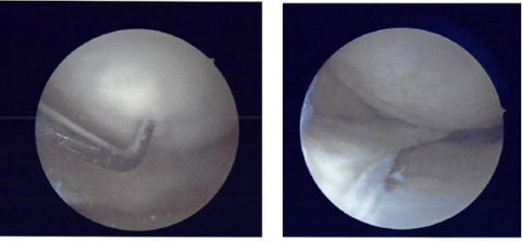 Case Study: Knee Arthroscopy: Medial and Lateral Meniscectomy, Cyclops ...