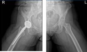 Case Study: Right Total Hip Arthroplasty in a 45 year-old patient ...