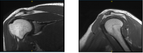 Case Study: Shoulder Scope: Labral Debridement, Rotator Debridement ...